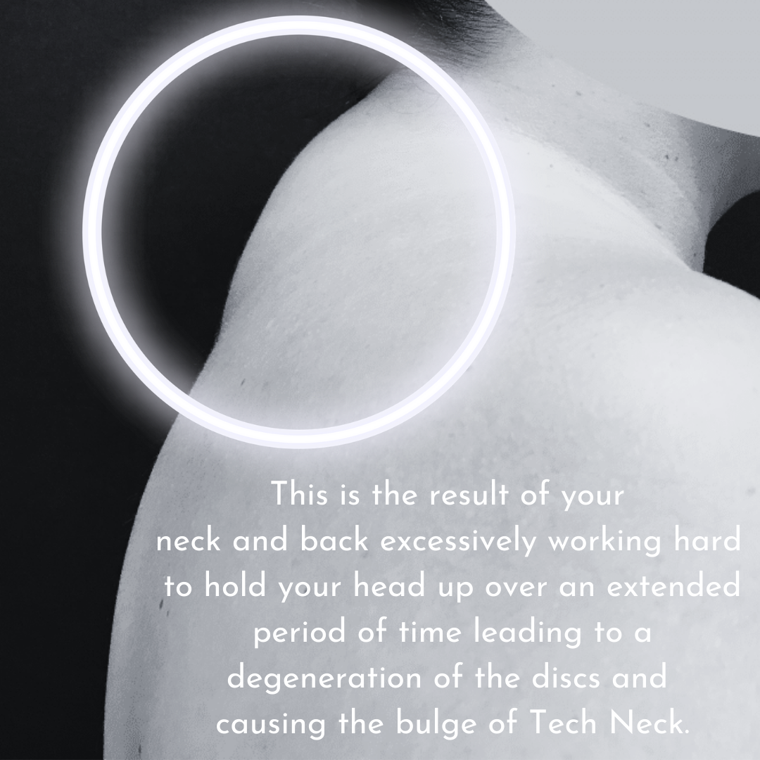 Tech Neck Side Effects East Cobb Spine & Sport Chiropractic